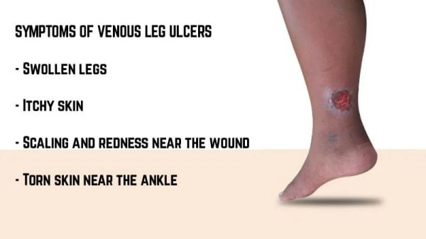 Venous Leg Ulcer: Symptoms, Causes, and Prevention