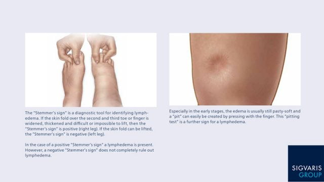 Lymphedema: Causes, Symptoms, and Treatment (Updated 2022)