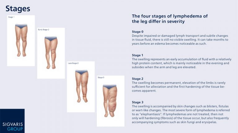 Lymphedema: Causes, Symptoms, and Treatment (Updated 2022)