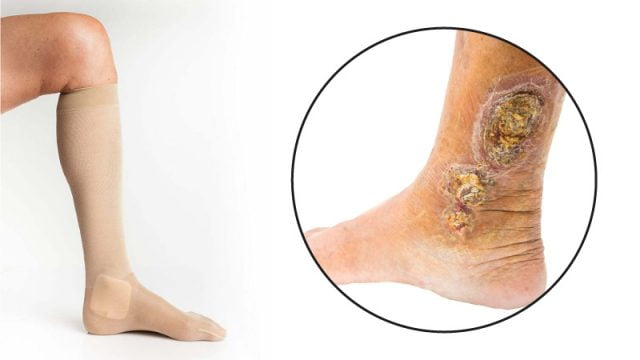 Leg Ulcers: Treatment And Causes